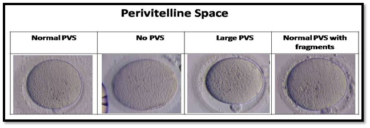 Oocyte Grading: Understanding Egg Quality for IVF Success